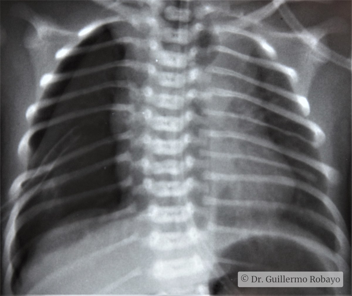 Atresia esofágo, fistula traqueoesofagica, esofagograma postop ...