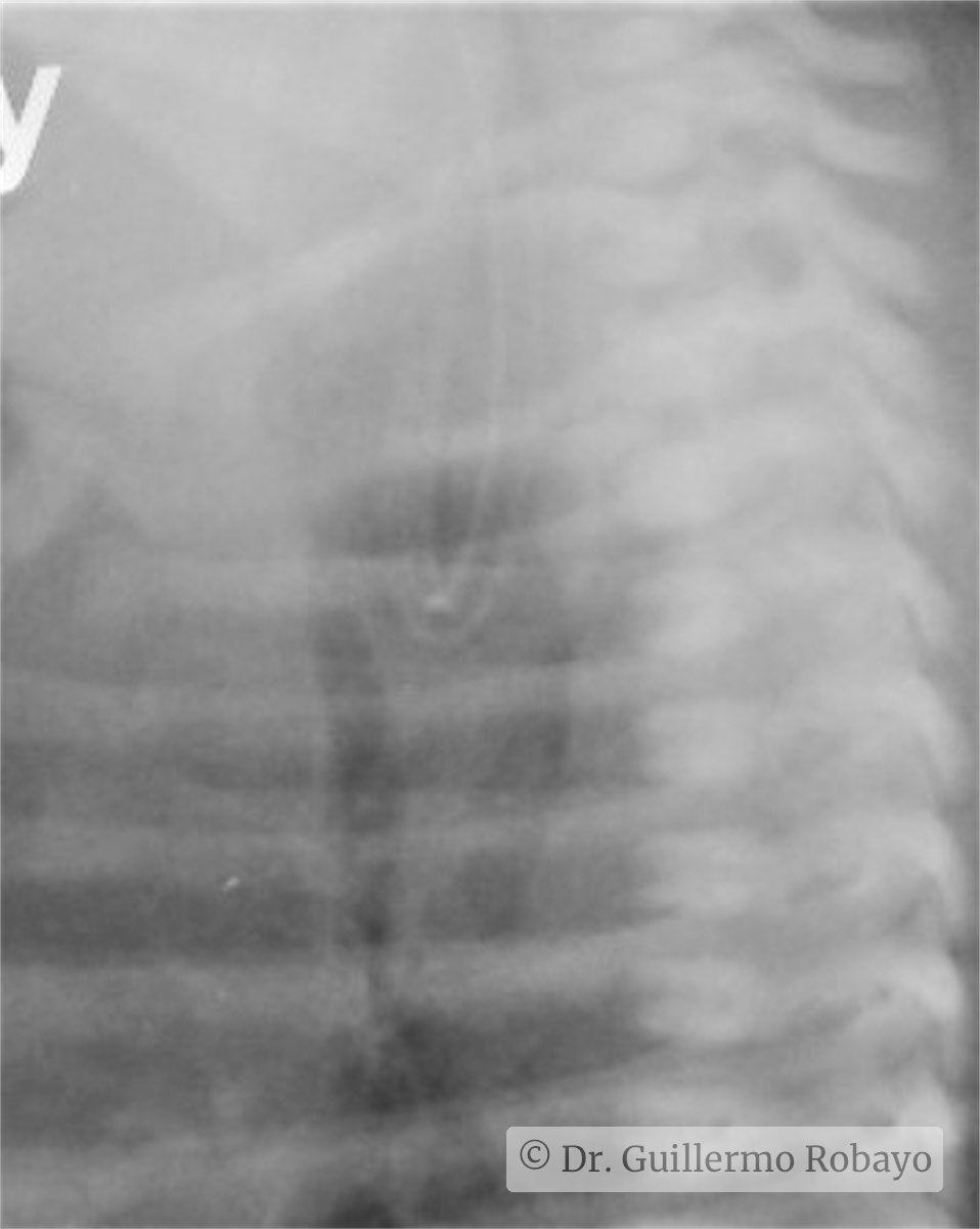 Atresia esofago sin fistula traqueo esofagica, costilla supernumeraria ...