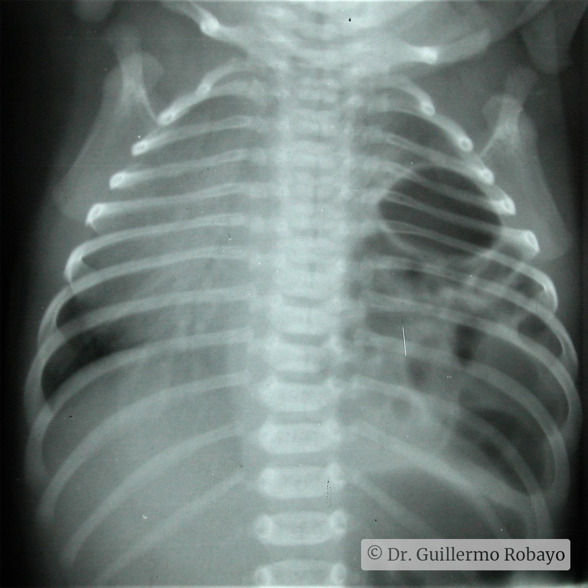 Hernia diafragmática congenita (HDC) Morgagni (anterior) izq 1988 – Dr ...