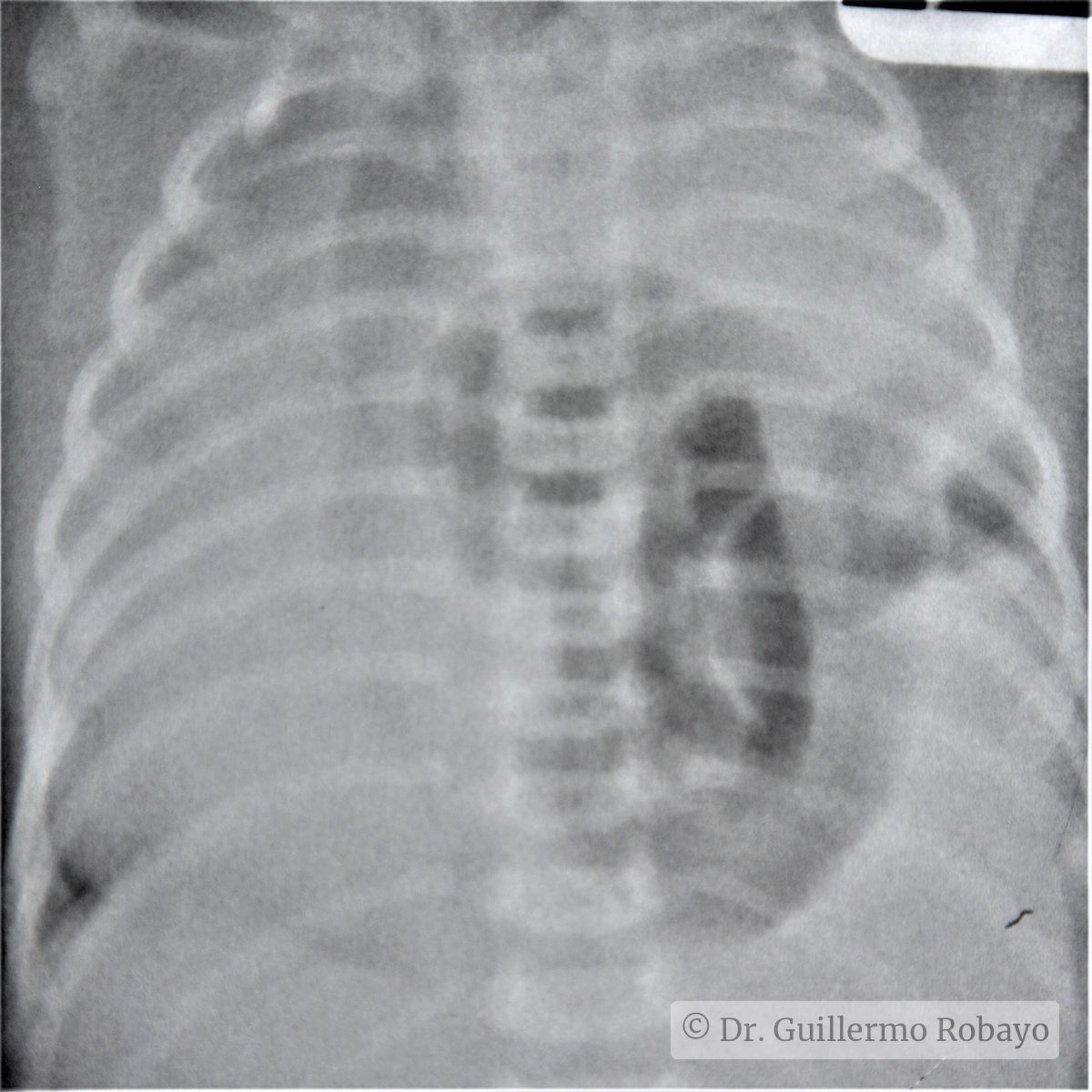 Hernia diafragmática congenita (HDC) Morgagni (centro anterior) izq ...