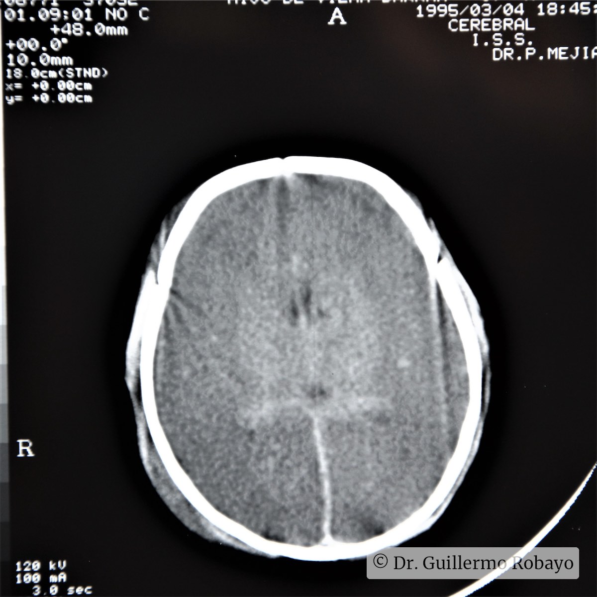 Isquemia cerebral difusa, edema cerebral 1995 – Dr. Guillermo Robayo