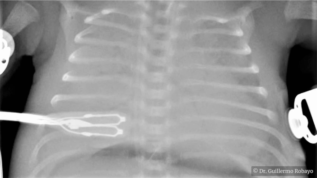 Neumoperitoneo, edema pulmonar, anasarca, serendipia – Dr. Guillermo Robayo