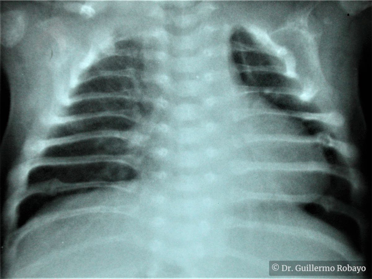 Osteogenesis imperfecta II (Vrolik) 2000 – Dr. Guillermo Robayo