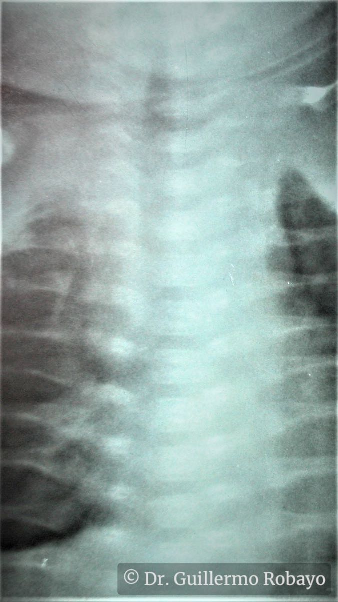 Osteogenesis imperfecta II (Vrolik) 2000 – Dr. Guillermo Robayo