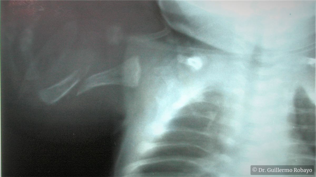 Osteogenesis imperfecta II (Vrolik) 2000 – Dr. Guillermo Robayo