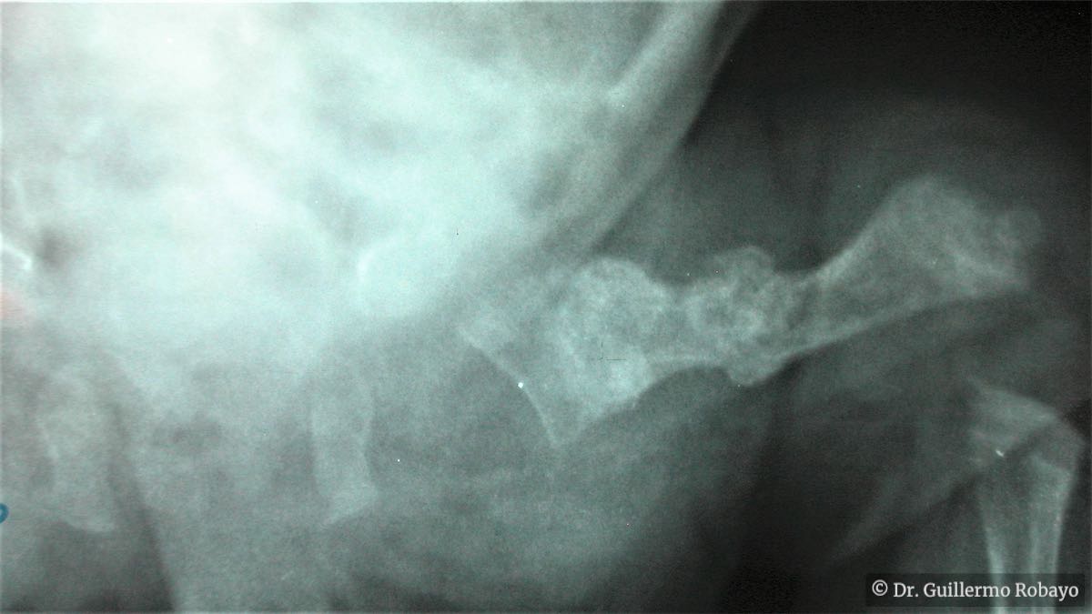 Osteogenesis imperfecta II (Vrolik) 2000 – Dr. Guillermo Robayo