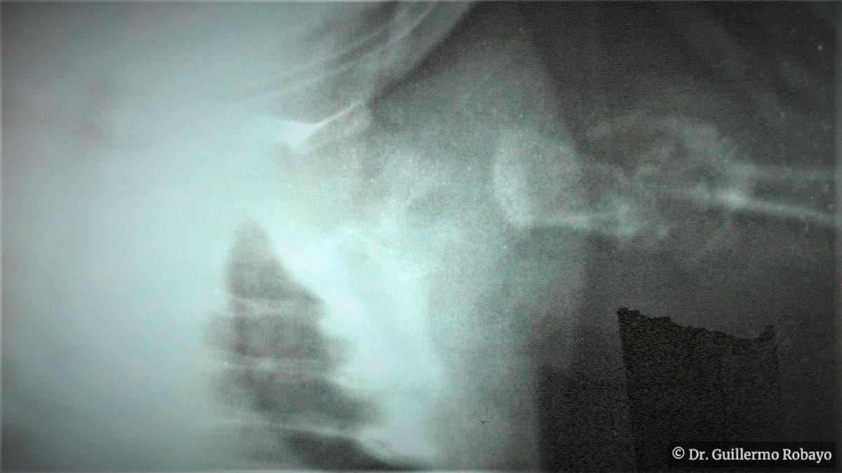Osteogenesis imperfecta II (Vrolik) 2000 – Dr. Guillermo Robayo