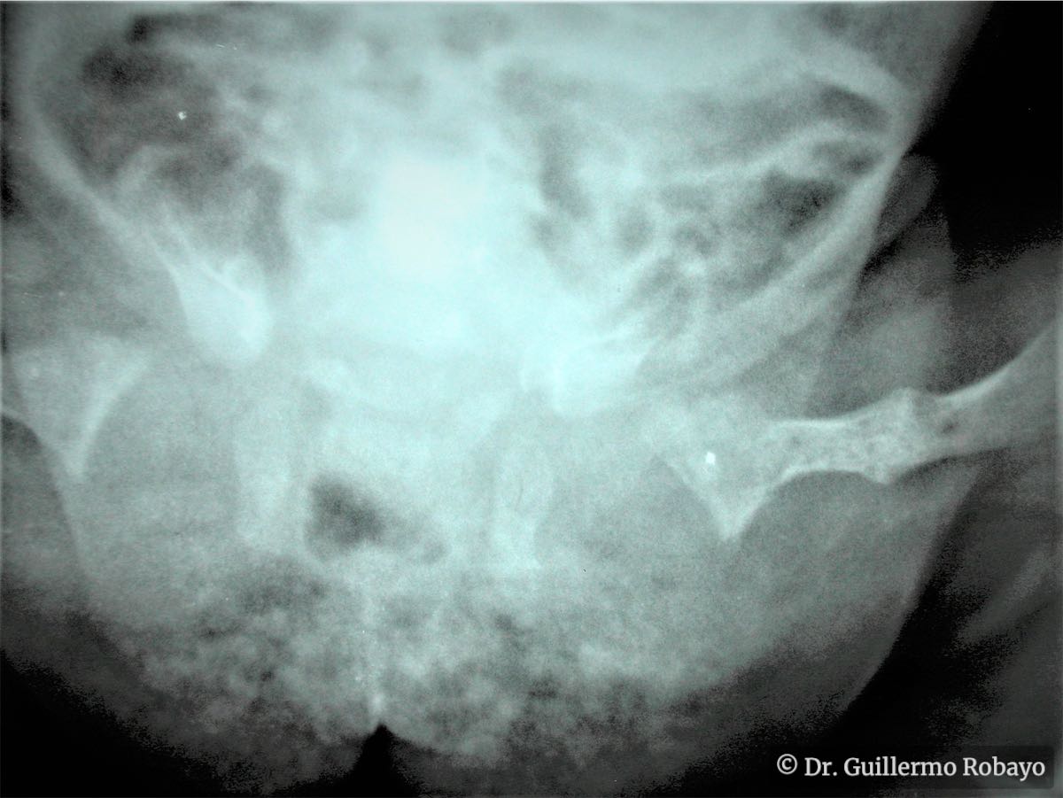 Osteogenesis imperfecta II (Vrolik) 2000 – Dr. Guillermo Robayo