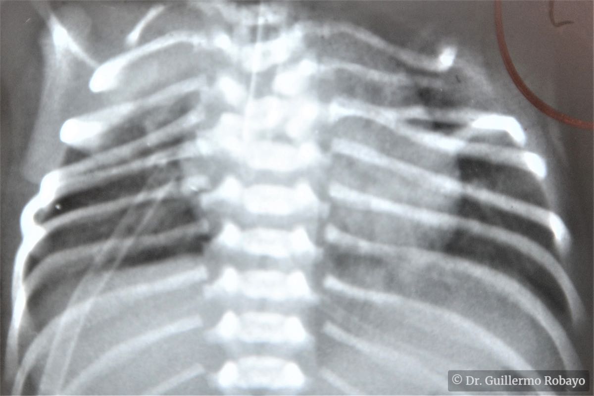 VACTER, hemivertebra, costillas fusionadas, cardiopatia, fistula TE ...