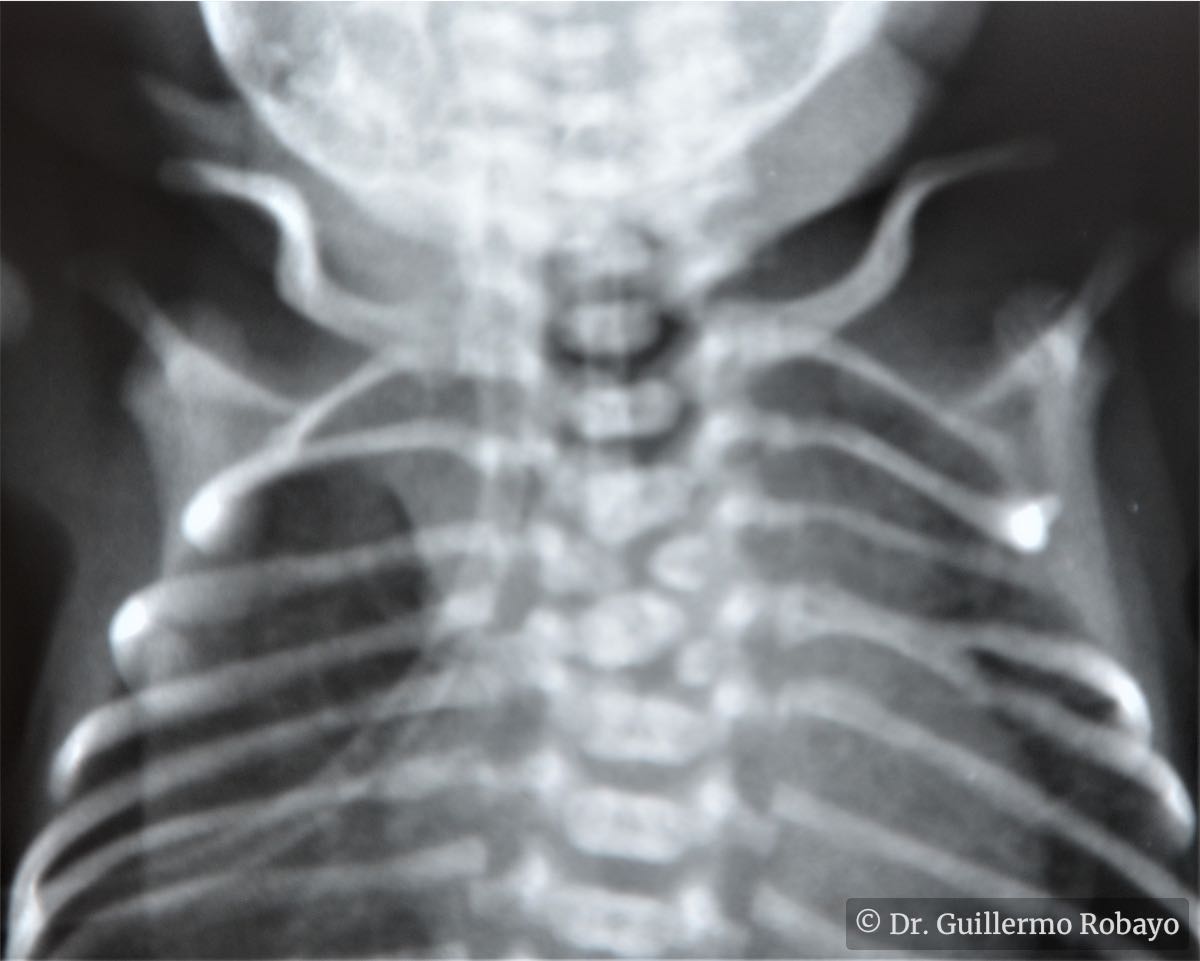 VACTER, hemivertebra, costillas fusionadas, cardiopatia, fistula TE ...